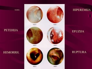 ULOGA EUSTAHIJEVE TUBE U NASTANKU I LIJEČENJU BAROTRAUME UHA | PPT