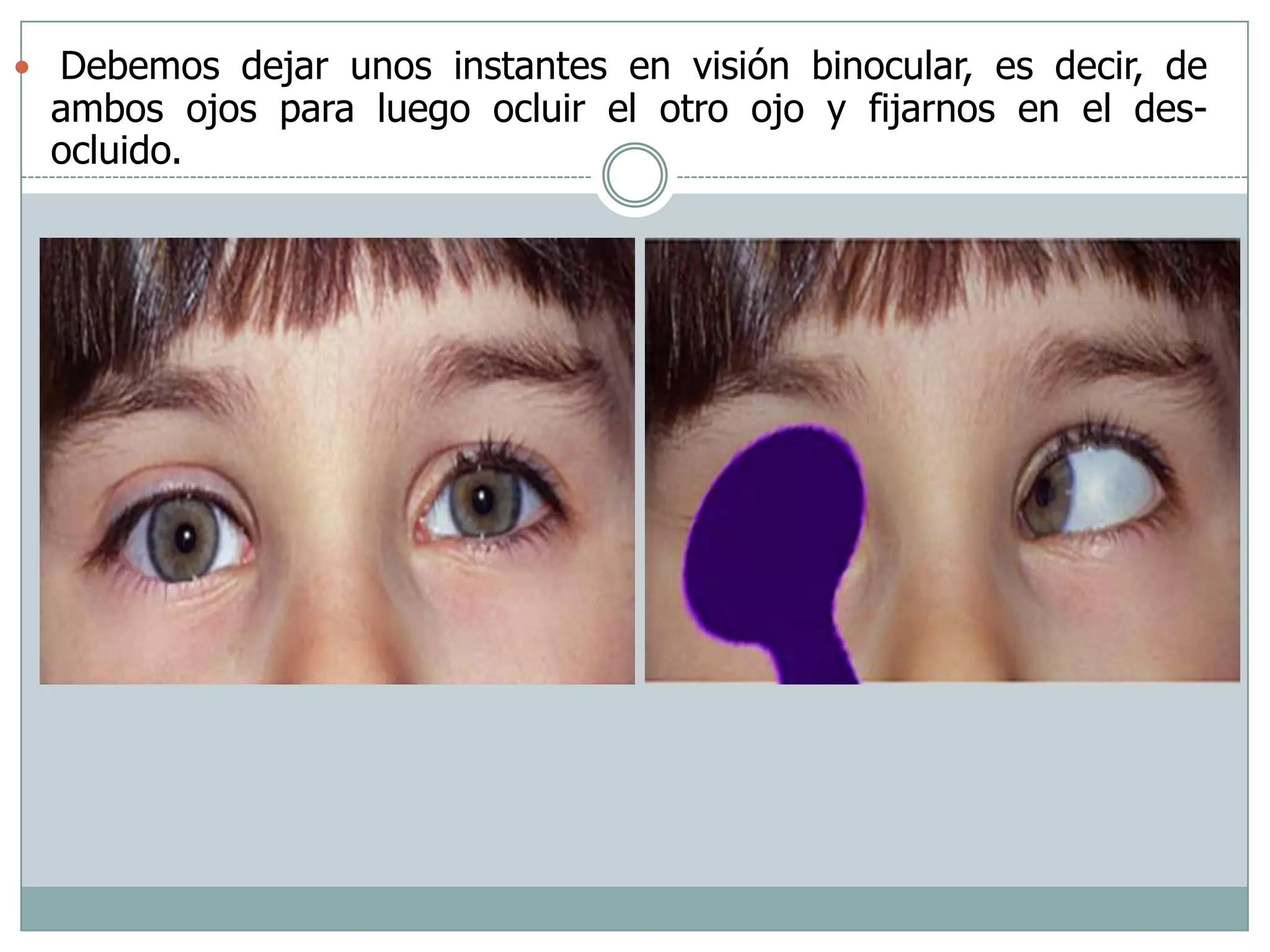 Cover Test Para Estrabismo | PPTX | Eye and Vision Conditions ...