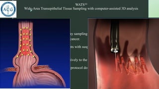 Barrets esophagus,risk factors,screening,AGA guidelines | PPTX
