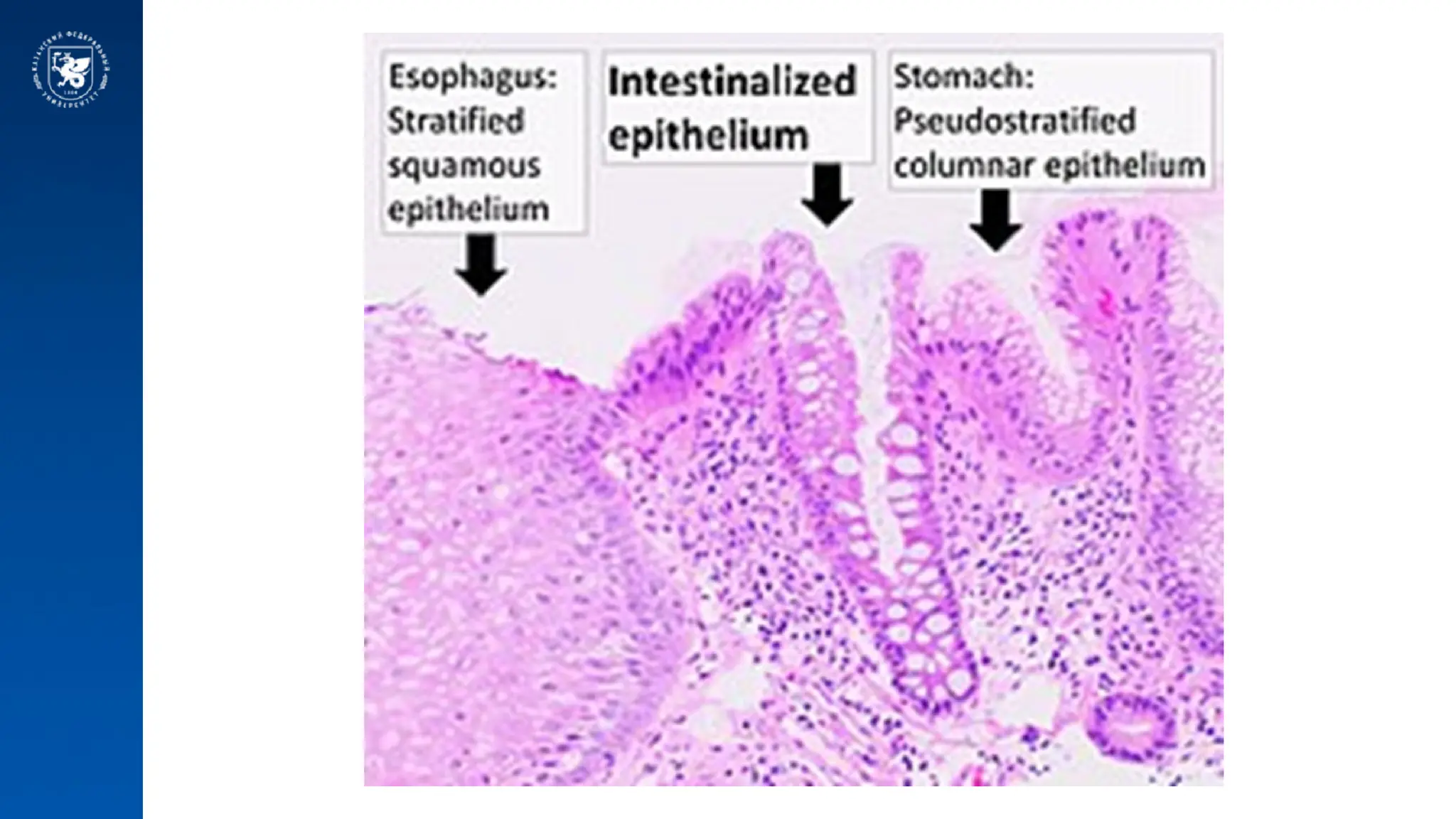 BARRETT ESOPHAGUS Gastroenterology Vousrse | PPTX
