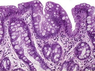 Barrett oesophagus journal club pathology | PPTX