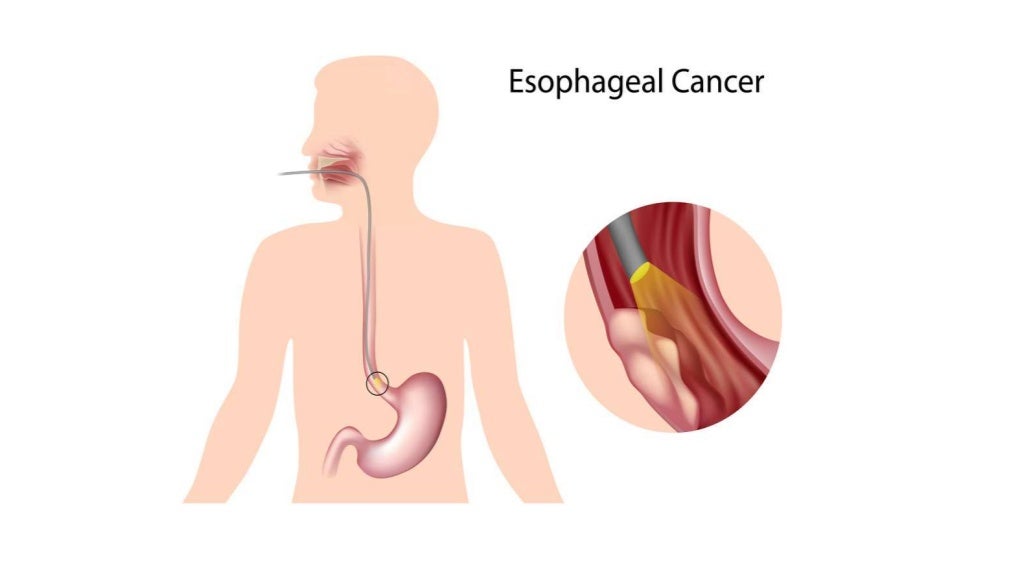Barretts Disease Barretts Esophagus Cancer Symptoms Barretts Esop