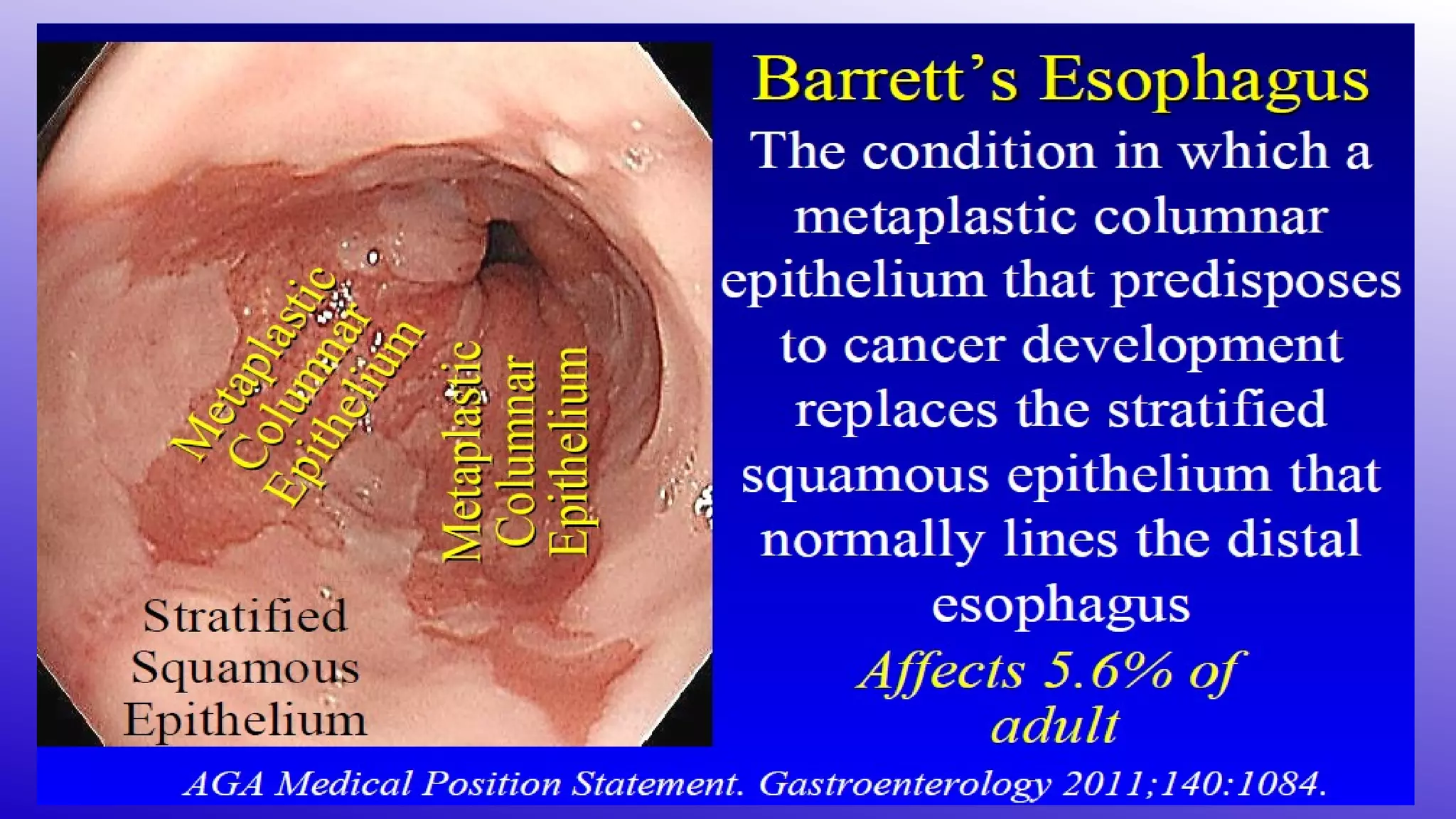 Barretts esophagus | PPS