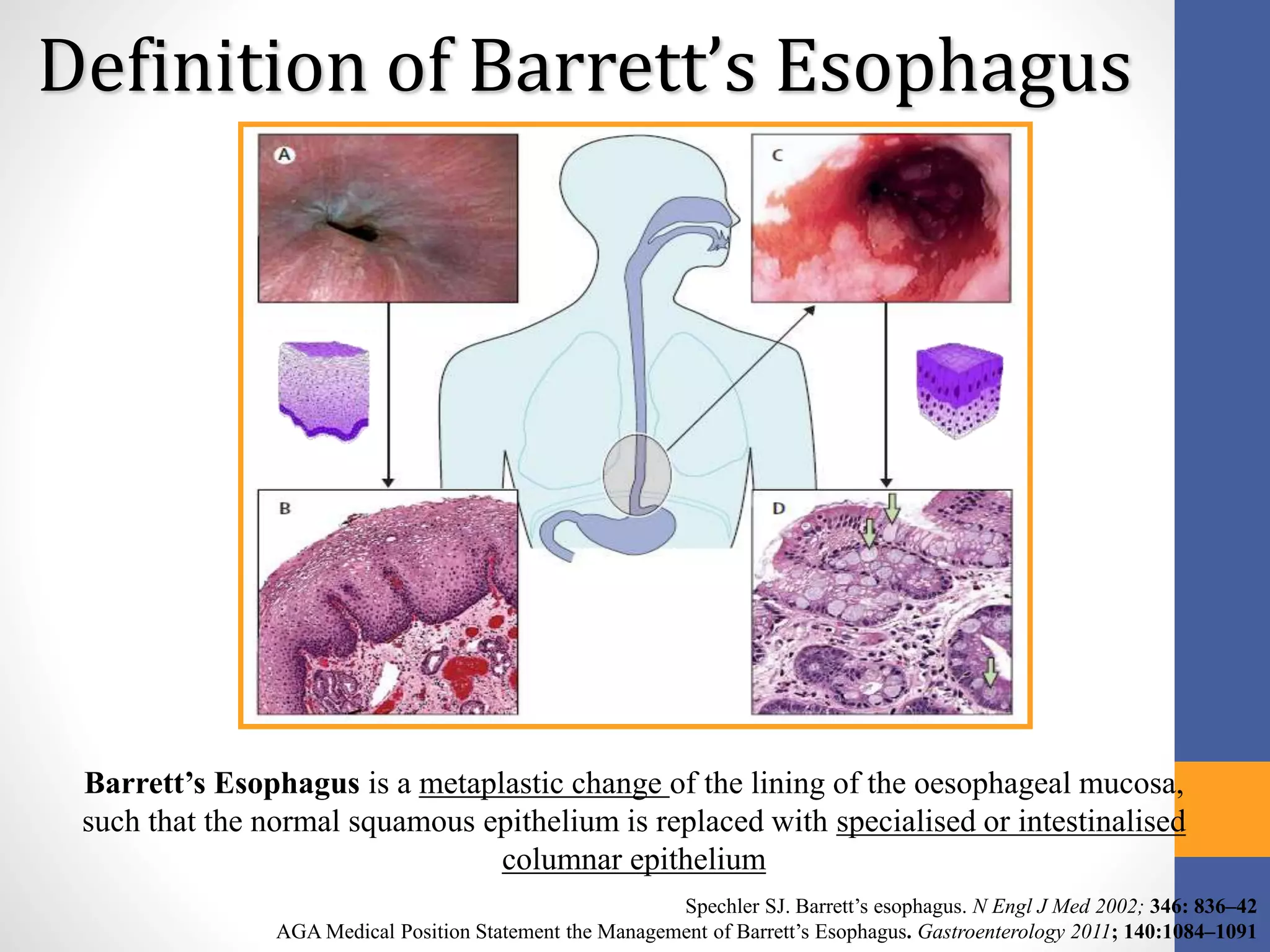 Dall'esofago di Barrett all'adenocarcinoma: fisiopatologia e diagnosi ...