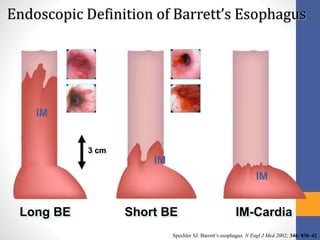 Dall'esofago di Barrett all'adenocarcinoma: fisiopatologia e diagnosi ...