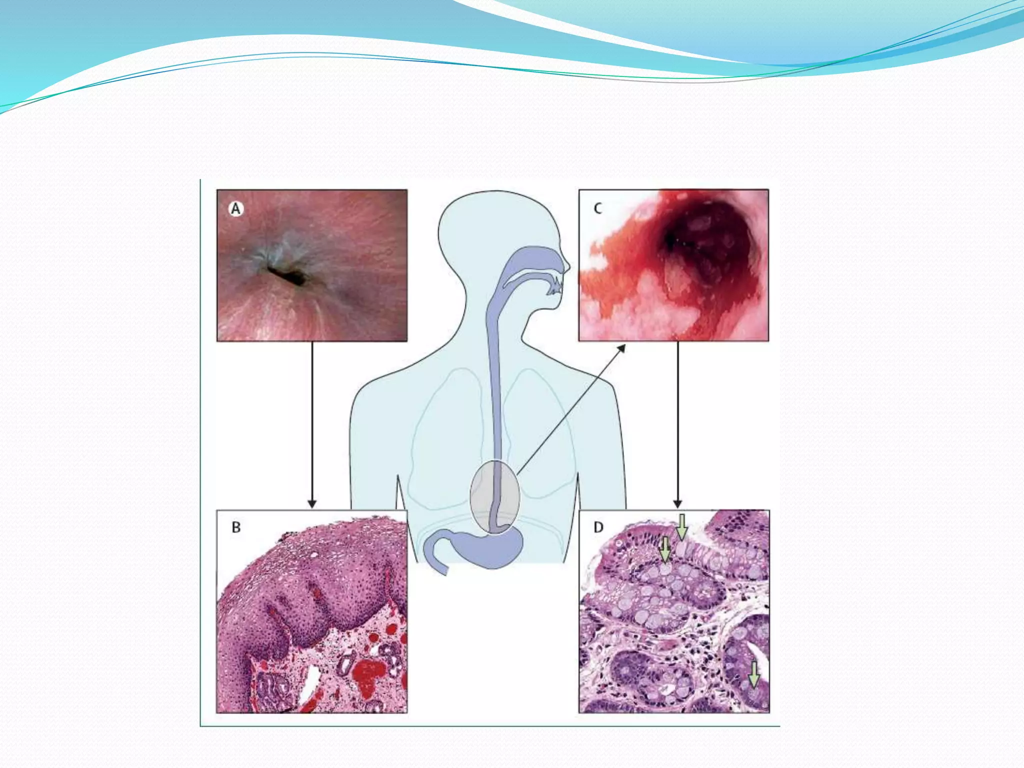 Barretts Esophagus BY DR P ABDUL SAMAD.pptx