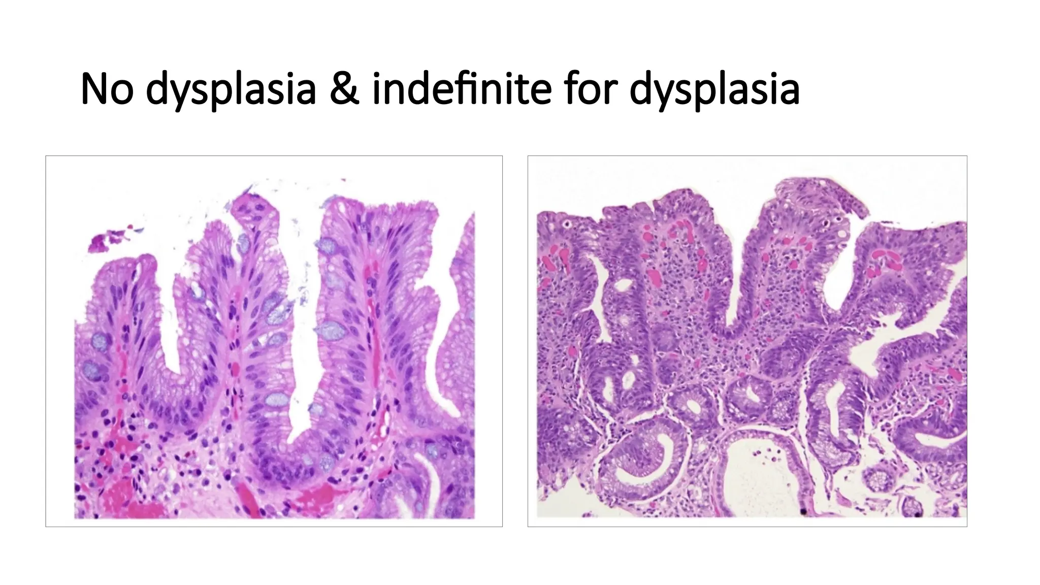 Barretts Esophagus -Diagnosis & management .pptx