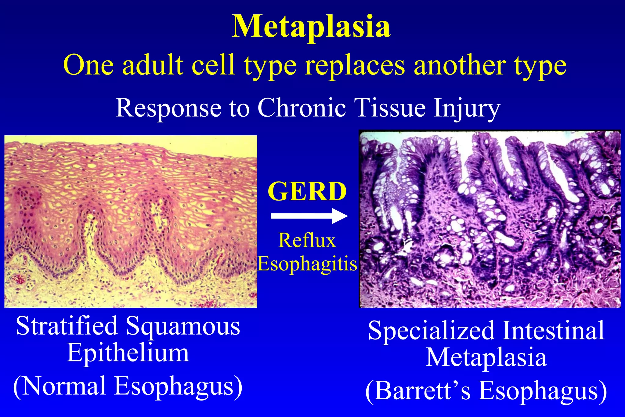 Barrett's esophagus; guidelines & new endoscopic techniques | PPT