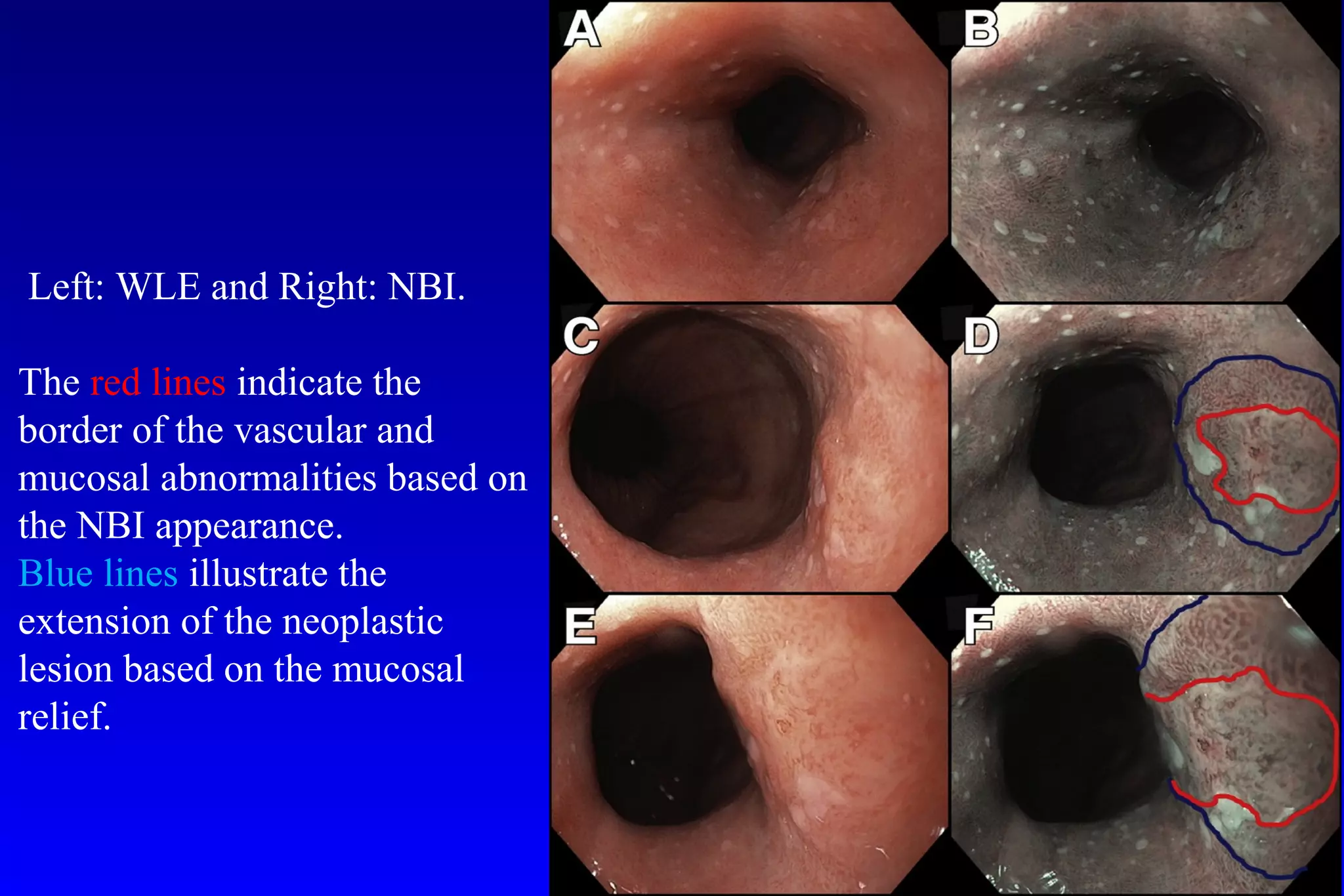 Barrett's esophagus; guidelines & new endoscopic techniques | PPT