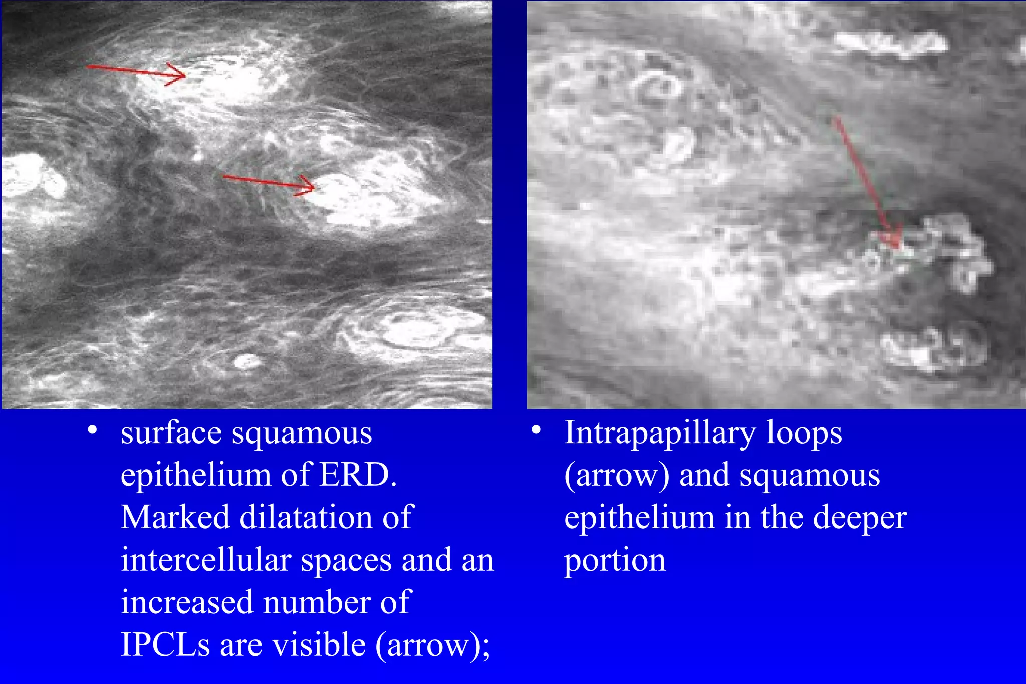 Barrett's esophagus; guidelines & new endoscopic techniques | PPT