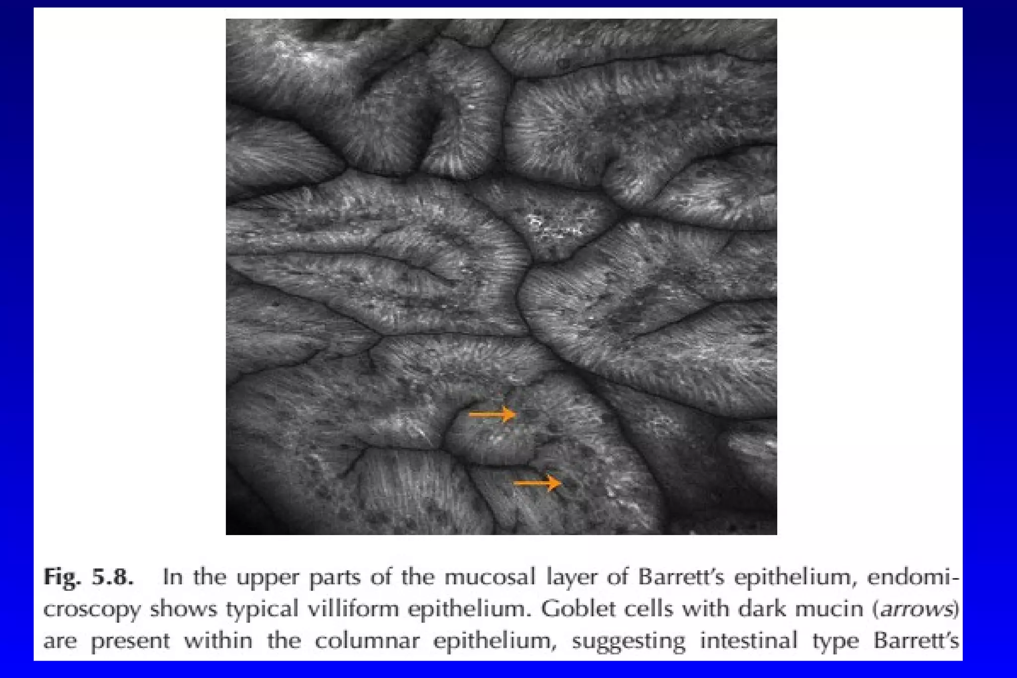 Barrett's esophagus; guidelines & new endoscopic techniques | PPT