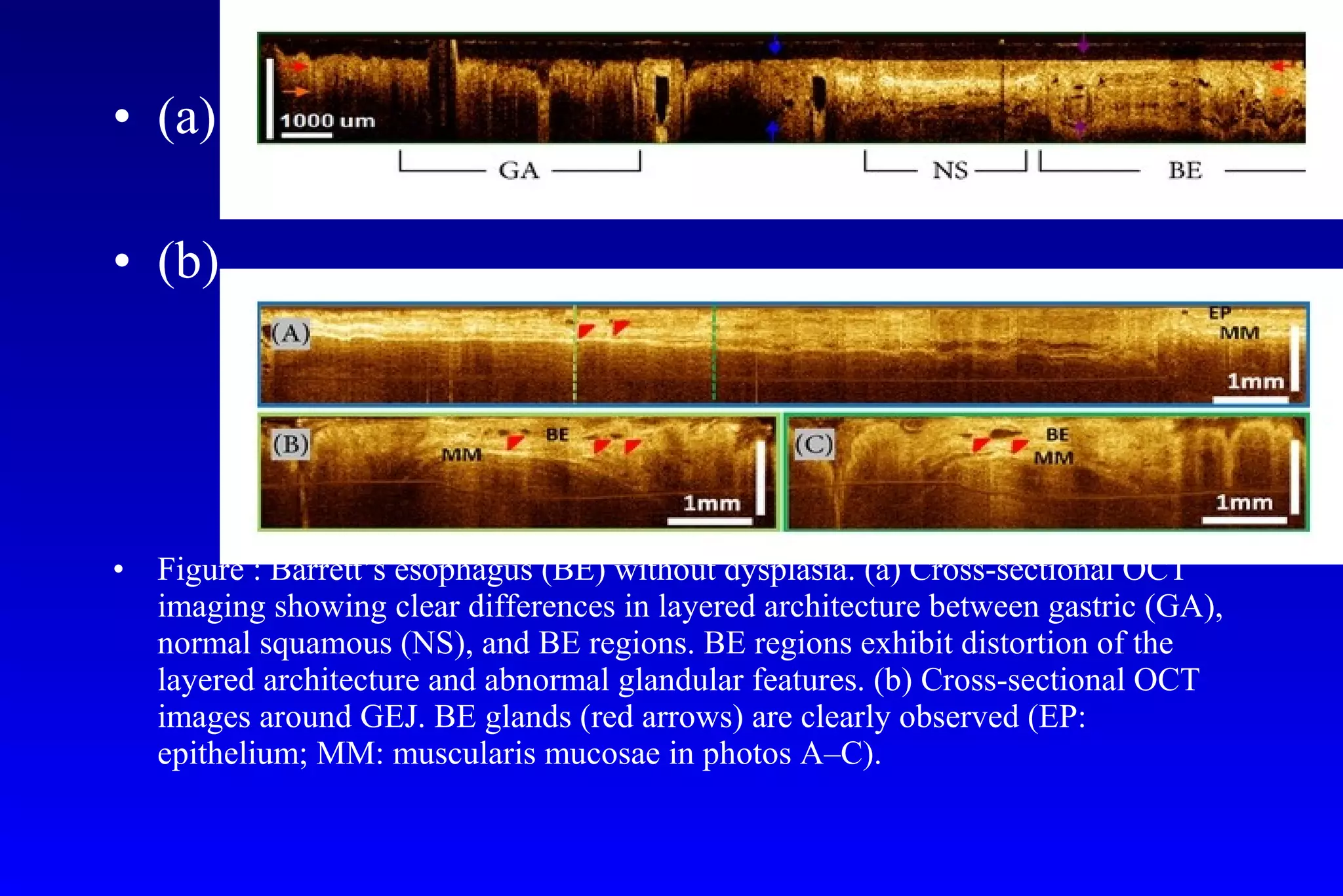 Barrett's esophagus; guidelines & new endoscopic techniques | PPT