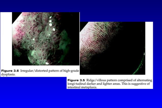 Barrett's esophagus; guidelines & new endoscopic techniques | PPT ...