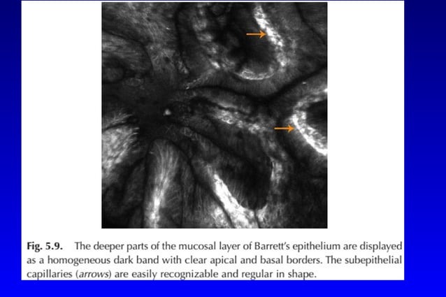 Barrett's esophagus; guidelines & new endoscopic techniques | PPT ...