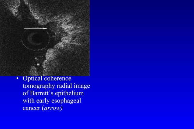 Barrett's esophagus; guidelines & new endoscopic techniques | PPT ...