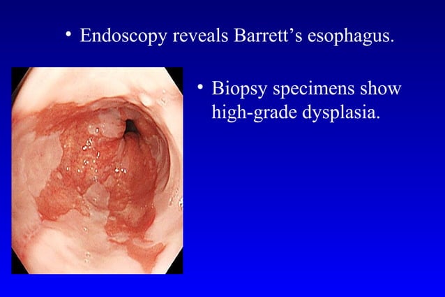 Barrett's esophagus; guidelines & new endoscopic techniques | PPT ...