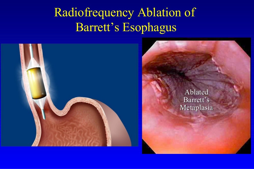 Endoscopic Biopsy Esophagus At Christian Brown Blog Endoscopic Biopsy Esophagus At Christian Brown Blog