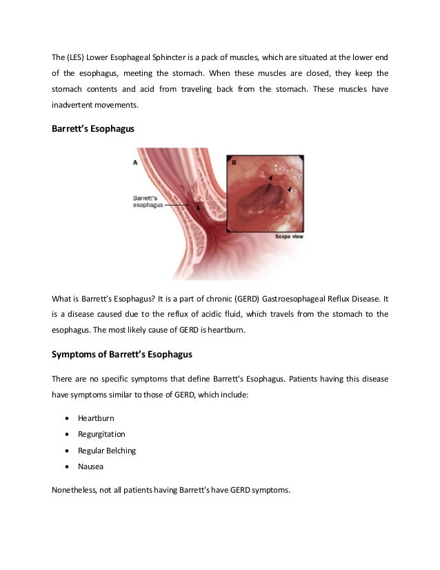 Barretts_Esophagus_Secrets_from_a_Guy_Who_Cured_Himself (1).pdf