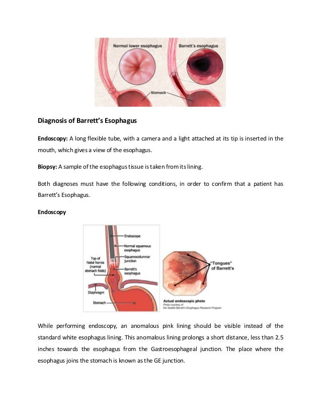 Barretts_Esophagus_Secrets_from_a_Guy_Who_Cured_Himself (1).pdf ...