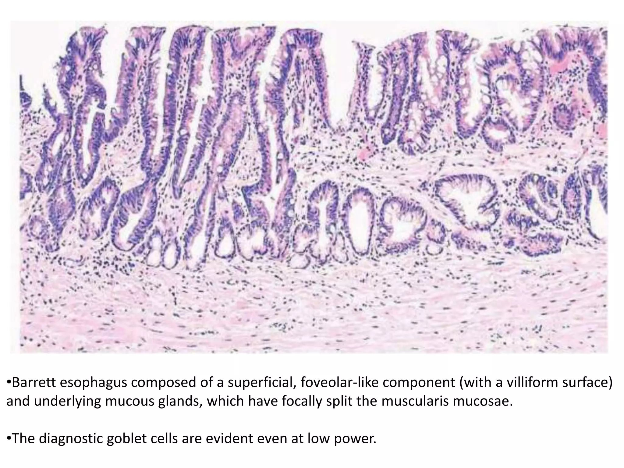 Barrett's Oesophagus for the Histopathologist. | PPTX