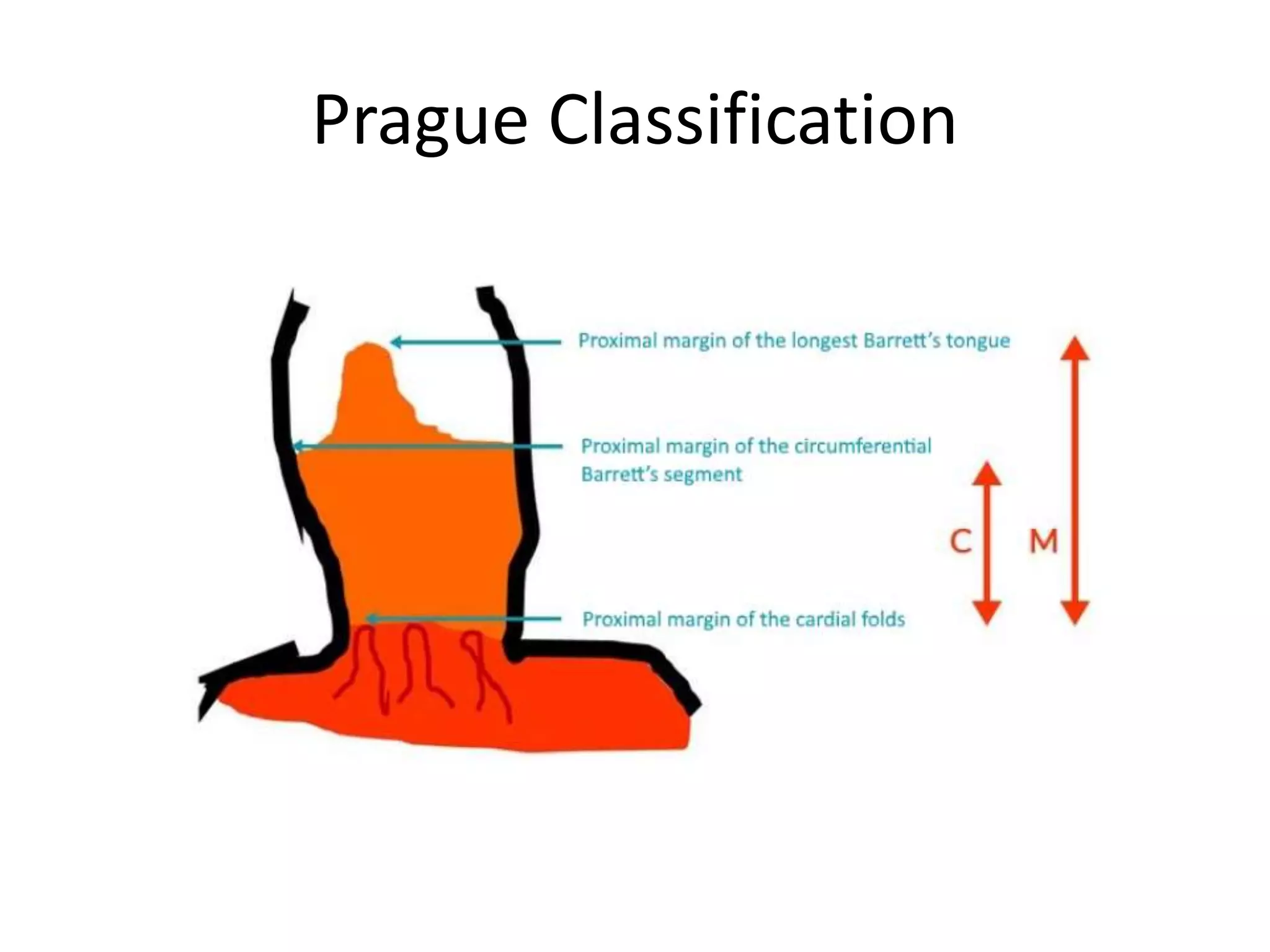 Barrett's Oesophagus for the Histopathologist. | PPTX