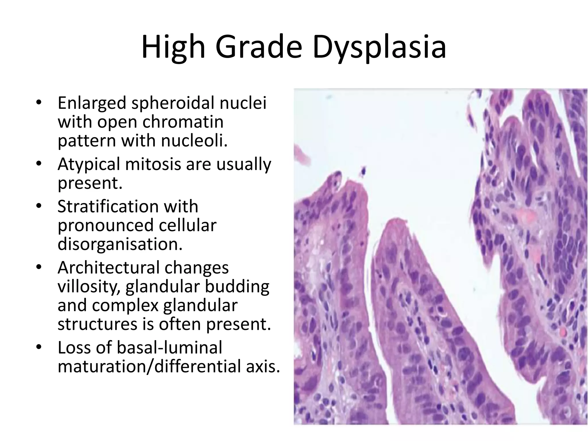 Barrett's Oesophagus for the Histopathologist. | PPTX