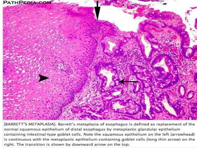 Barrett's Oesophagus for the Histopathologist.