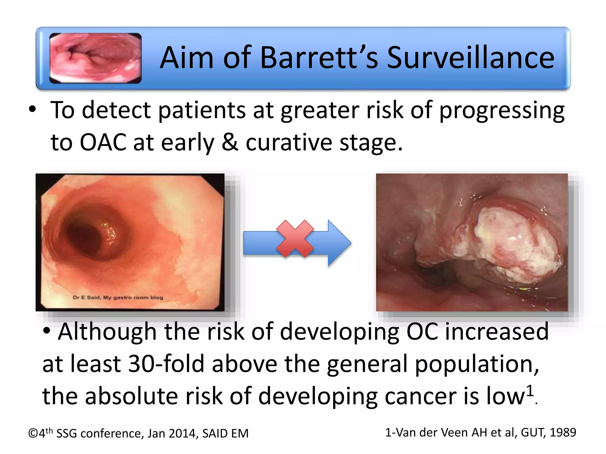 Barrett’s surveillance and early management of ca oesophagus | PPTX