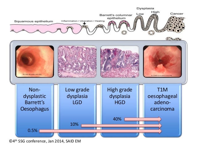 Barrett’s surveillance and early management of ca oesophagus
