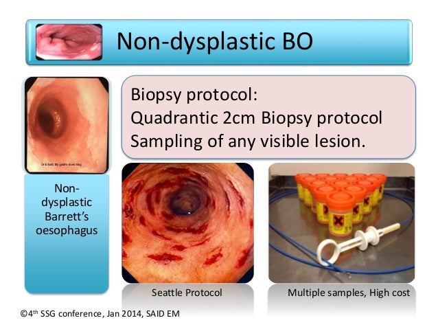 Barrett’s surveillance and early management of ca oesophagus