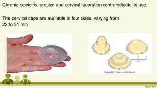 Barrier contraceptives | PPT