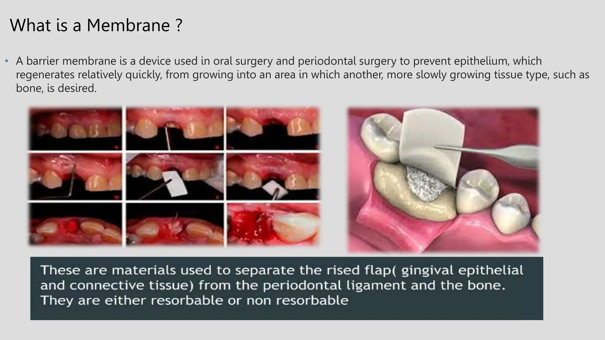 Barrier membranes in regenerative periodontal and implant surgeries.pptx