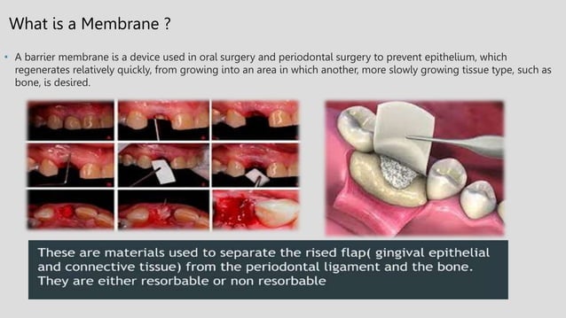 Barrier membranes in regenerative periodontal and implant surgeries ...
