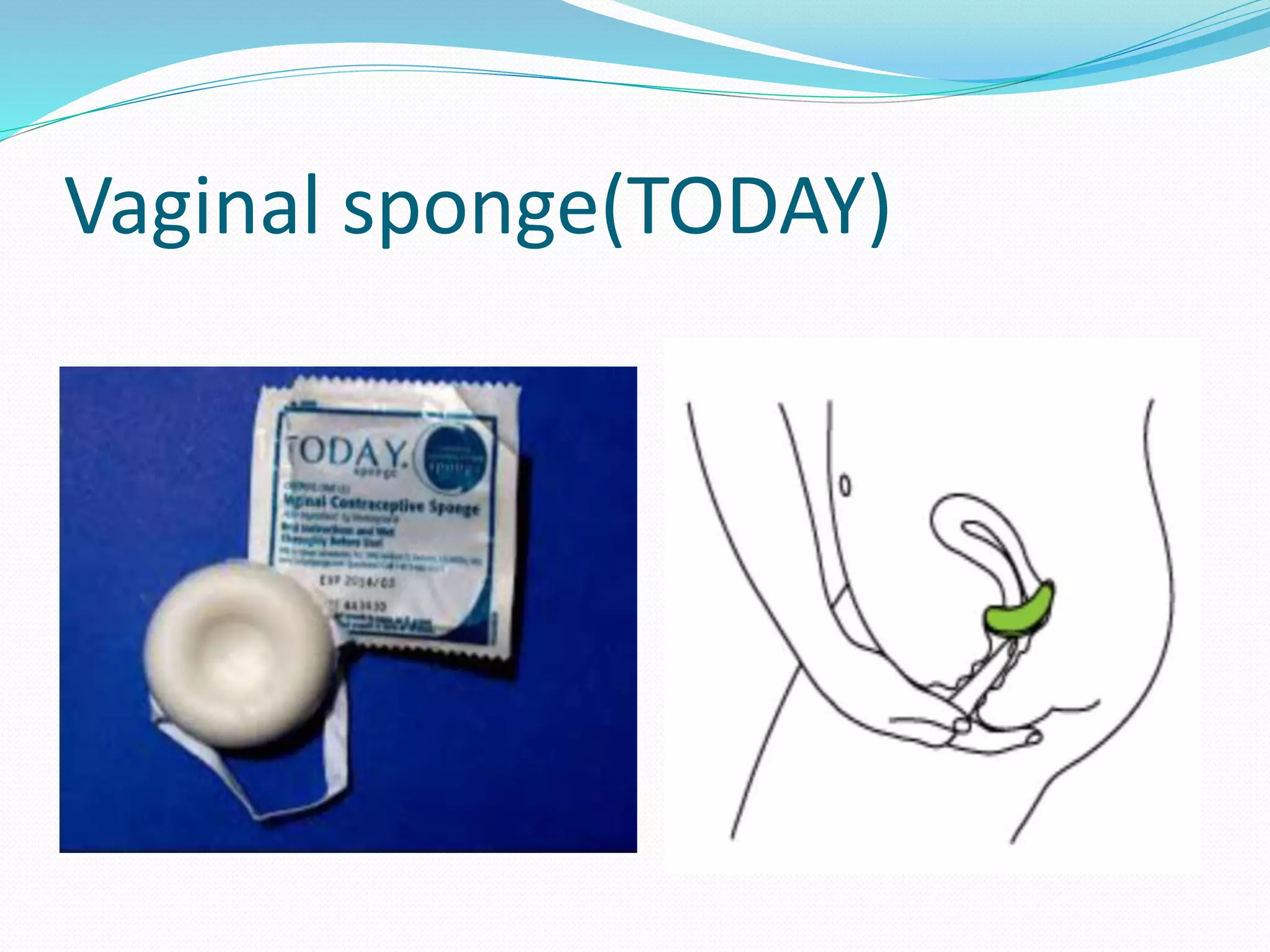 Barrier Methods For Contraception Pptx