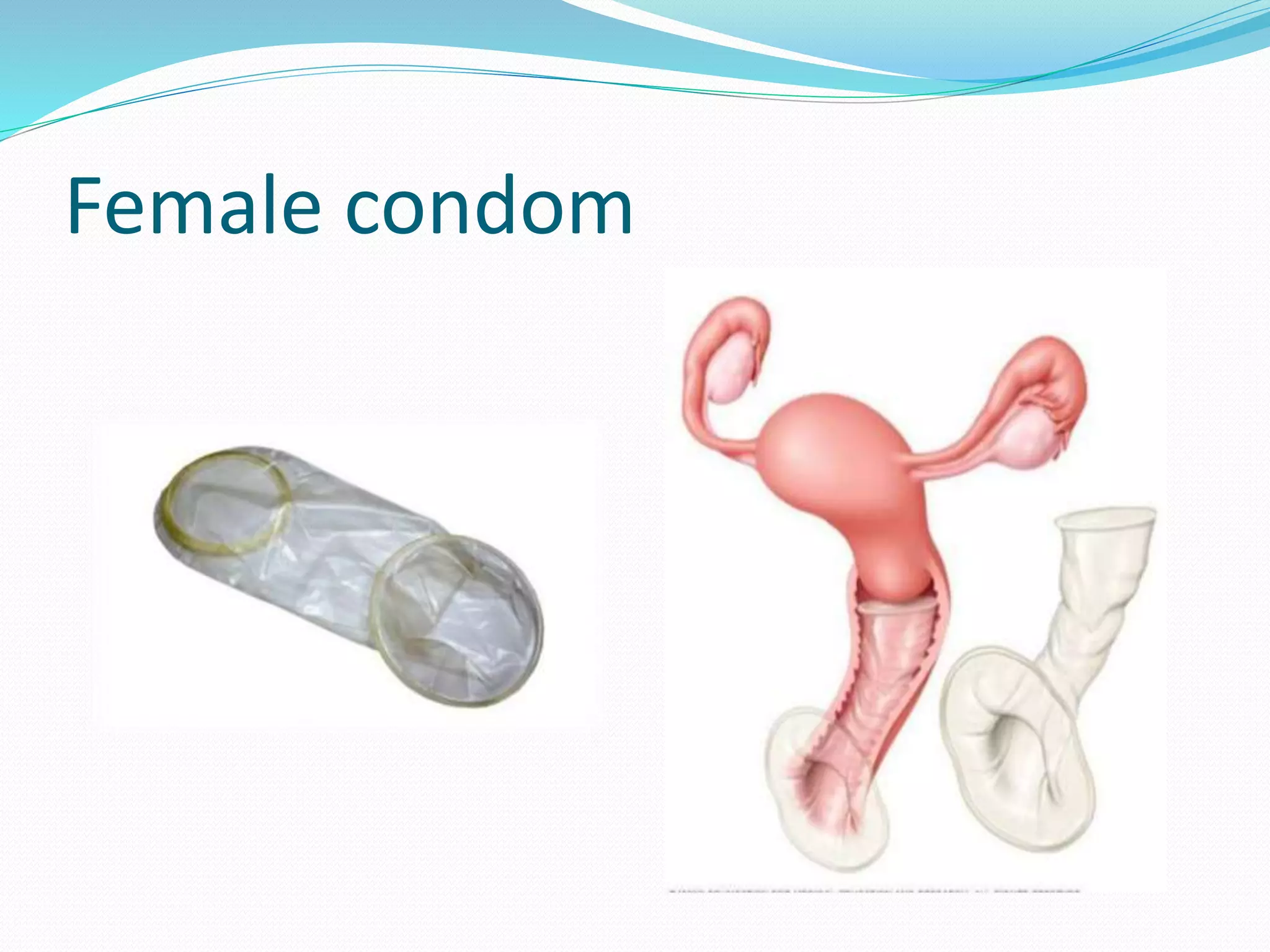 Barrier methods for Contraception | PPTX