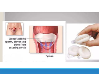 Barrier methods of Contraception- obg ppt | PPTX
