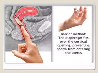 Barrier methods of Contraception- obg ppt | PPTX