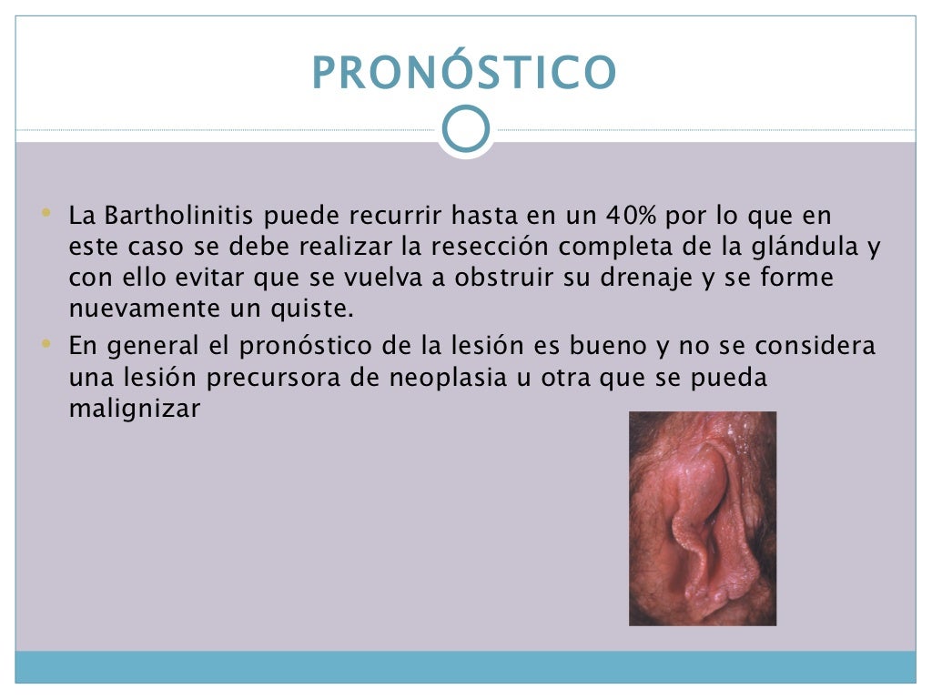 Bartolinitis