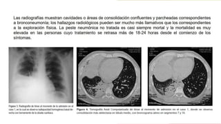 BARTONELOSIS VERRUGA PERUANA FIEBRE .pdf