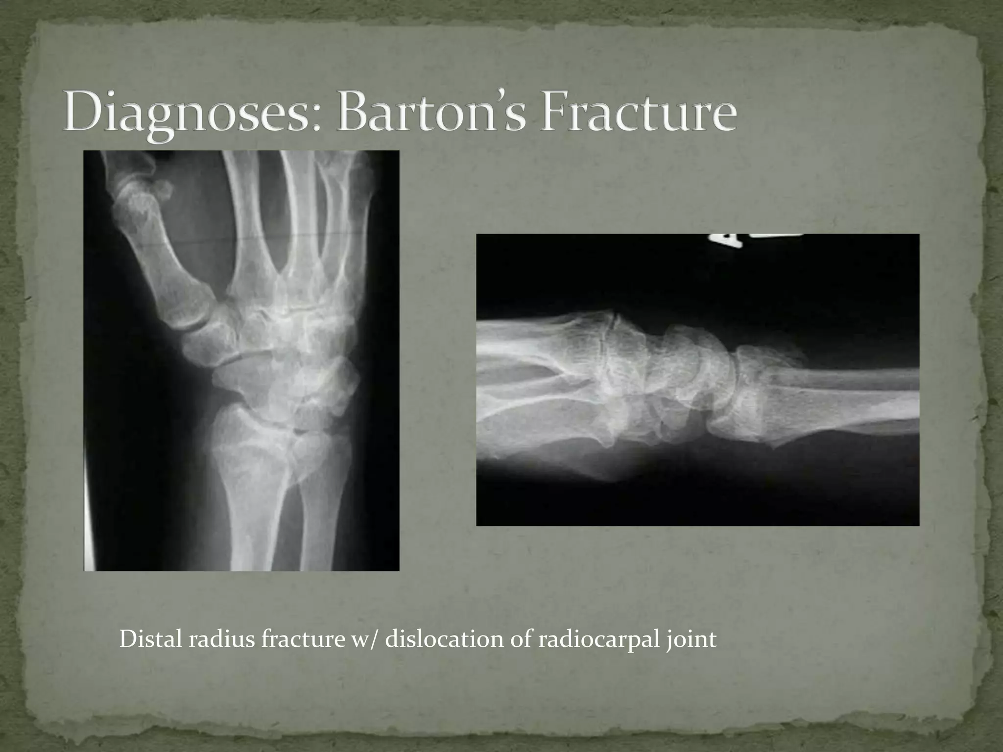 Barton’s fracture | PPTX