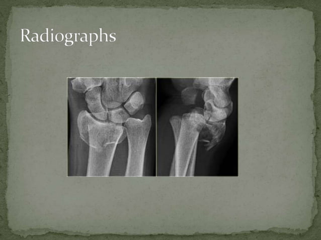 Barton’s fracture | PPTX | Death, Injury, or Military Conflict ...