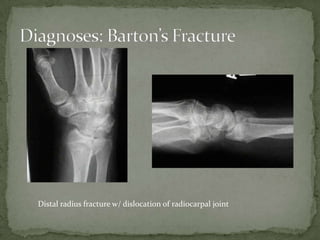 Barton’s fracture | PPTX
