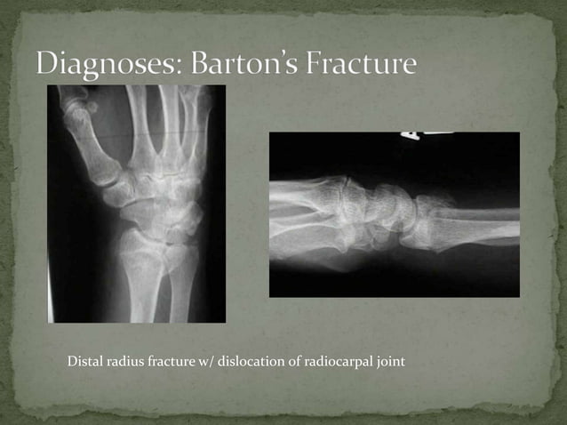 Barton’s fracture | PPTX | Death, Injury, or Military Conflict ...