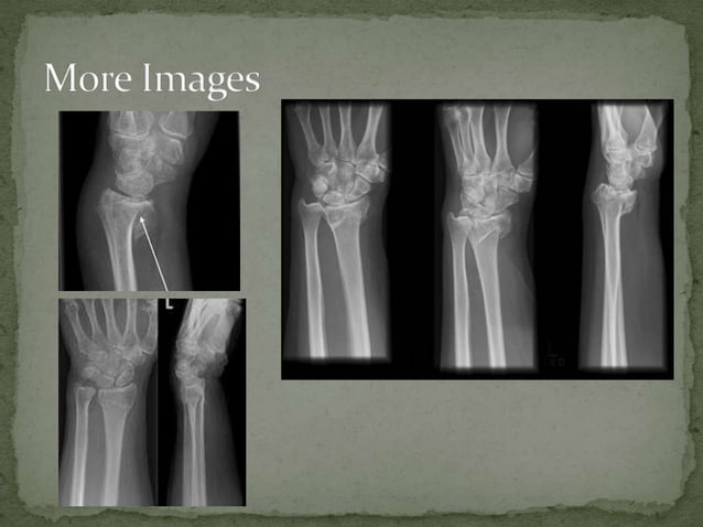 Barton’s fracture | PPT