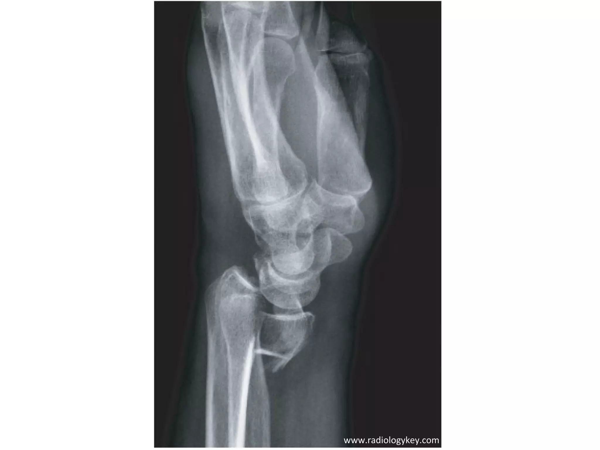 Bartons fracture volar | PPT