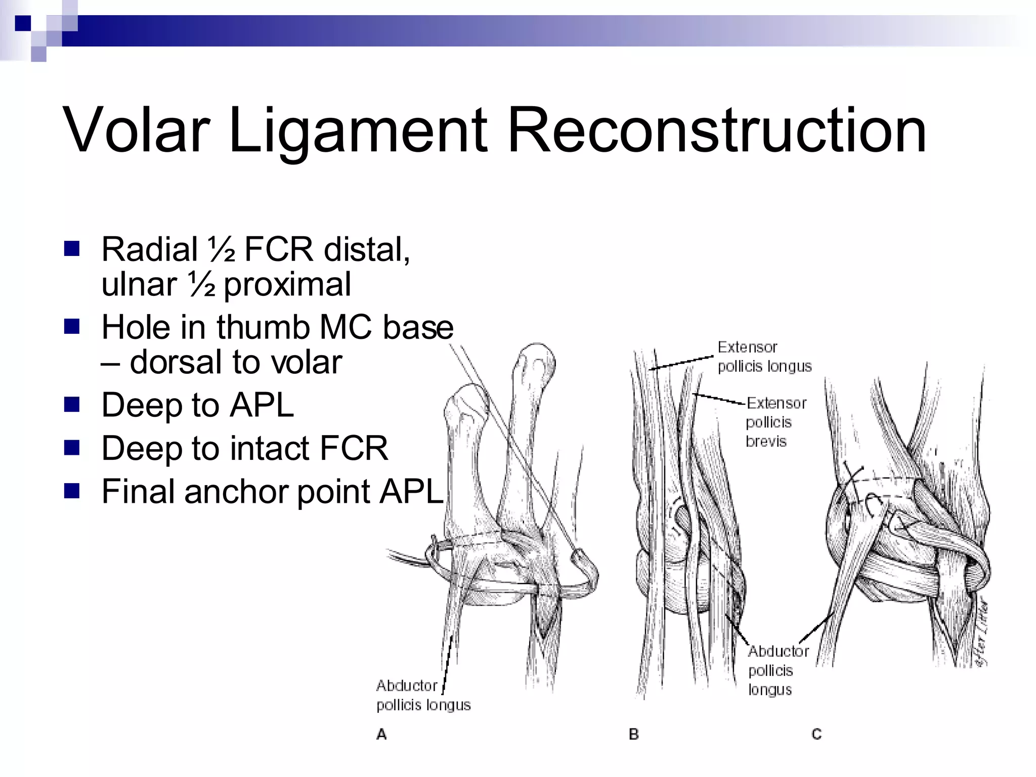 Basal Joint Arthritis Of The Thumb | PPT