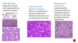 Basal Cell Adenoma | PPTX