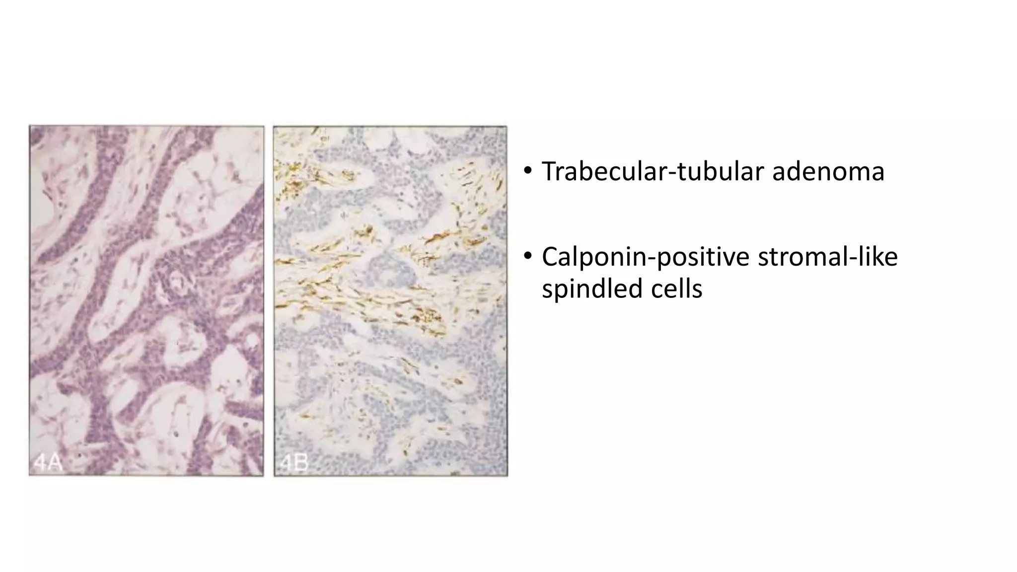 Basal cell Adenoma and Canalicular Adenoma Doctor Faris Alabeedi MSc ...