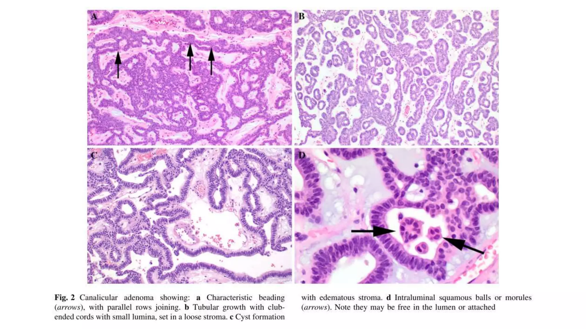 Basal cell Adenoma and Canalicular Adenoma Doctor Faris Alabeedi MSc ...