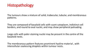 Basal cell Adenoma and Canalicular Adenoma Doctor Faris Alabeedi MSc ...